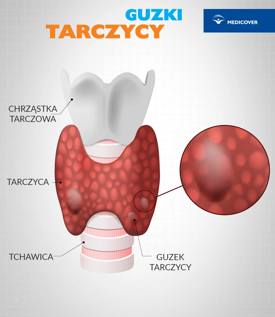 Guzki tarczycy | Czy guzki tarczycy są groźne?
