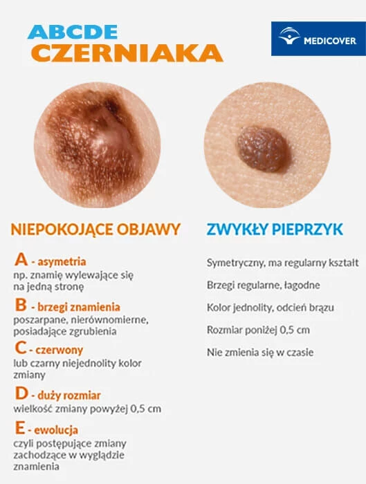 Czerniak | Objawy i diagnostyka nowotworu skóry